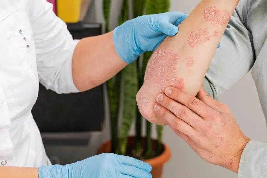 Eczema Specialist in Atlantis & Boynton Beach, FL